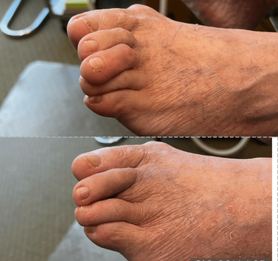 Elective 3rd toe amputation